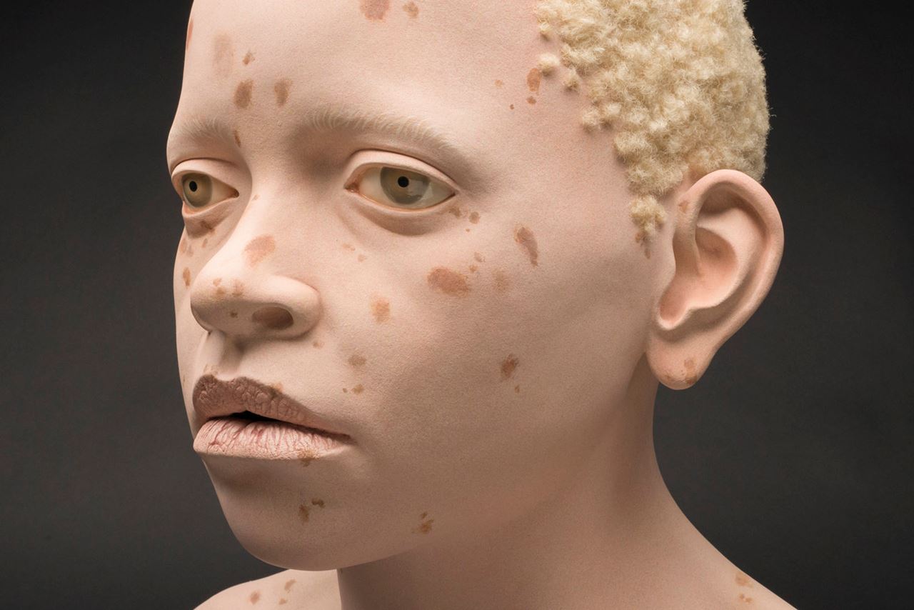 Africa Child with Albinism No. 3 | Hieronymus Objects